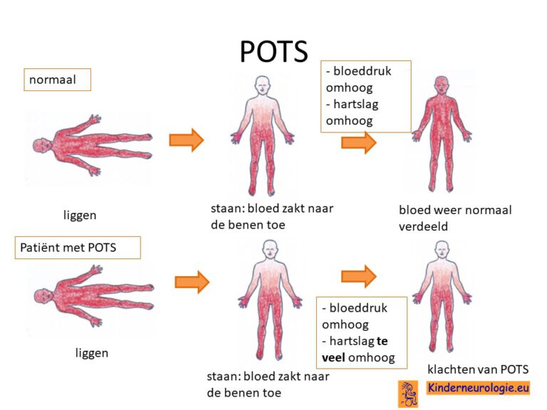 Wat is POTS – Mijn leven met ME/CVS en POTS
